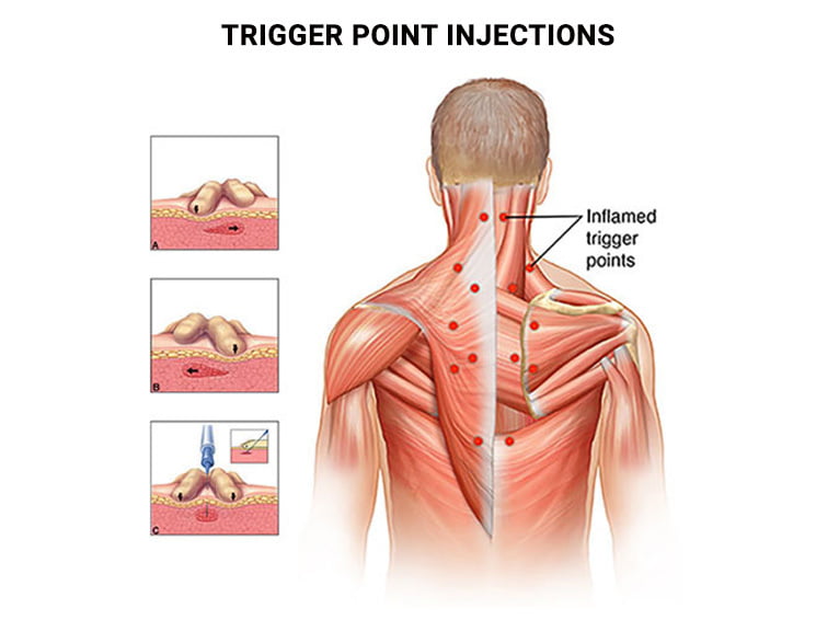 Trigger Point Injections in NYC & NJ | Advanced Headache Center